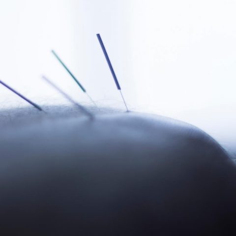 Trigger Point Dry Needling Physiotherapy Benefit Physio